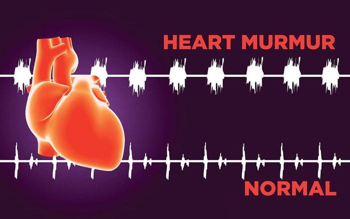 Heart Murmur Symptoms & Care