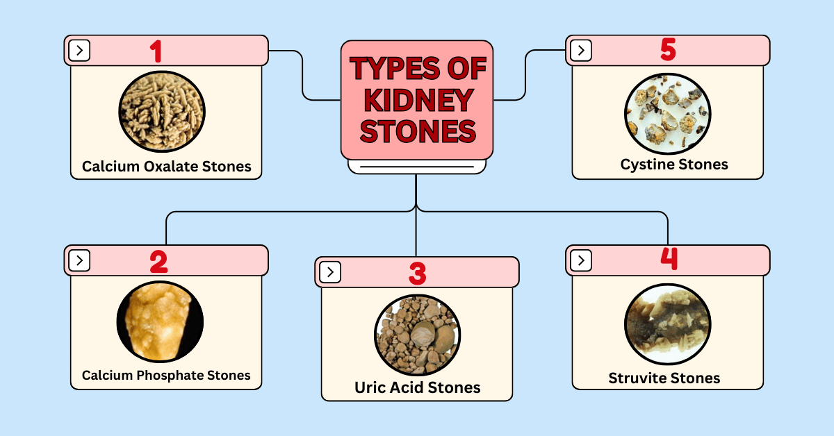 Kidney Stones and Treatment in Mumbai